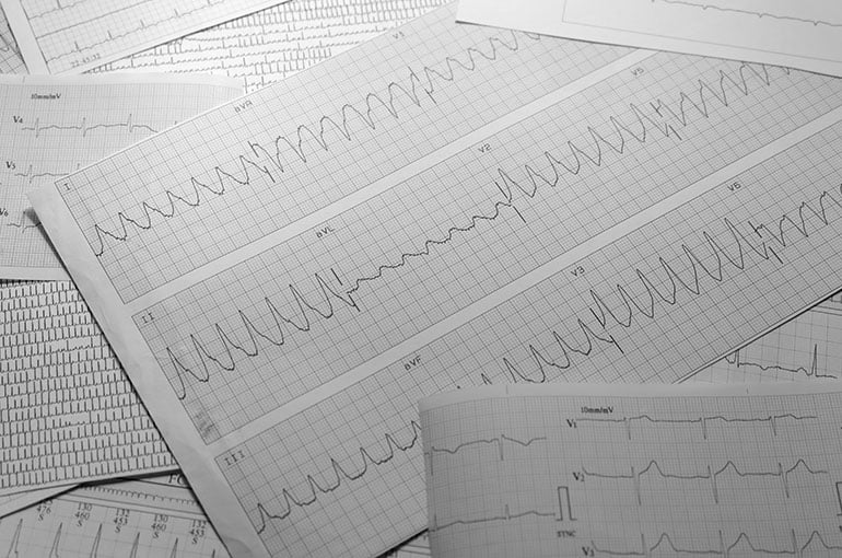 Arrhythmias - Abnormal heart rhythms - BHF