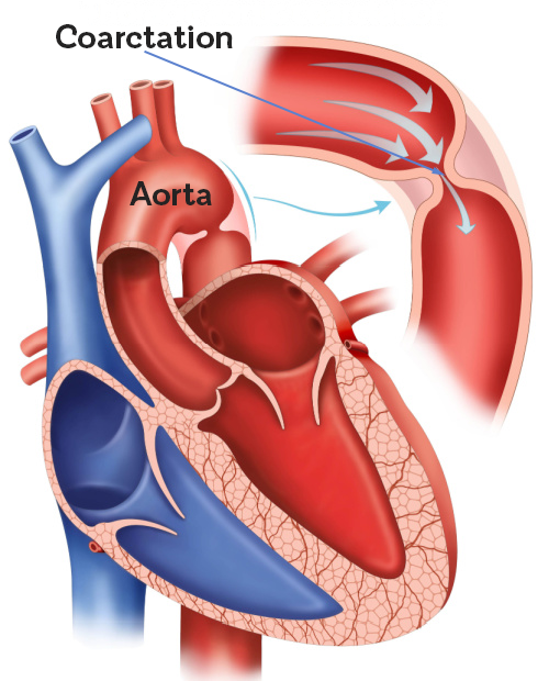 Coarctation of the aorta - BHF