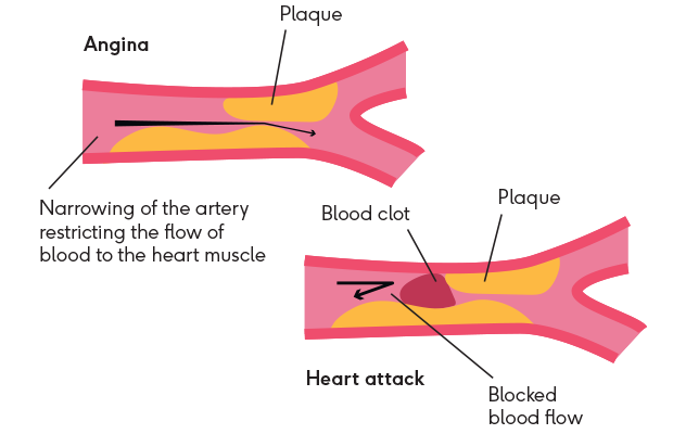 Angina - Causes, symptoms & treatments - BHF