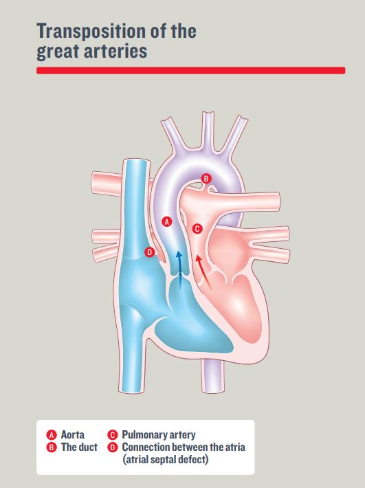 Transposition of the great arteries (TGA) - BHF