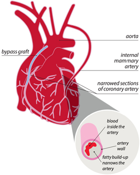 Coronary artery bypass surgery (CABG) - BHF