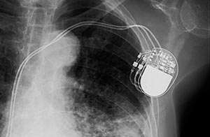Frequently asked pacemaker questions - BHF