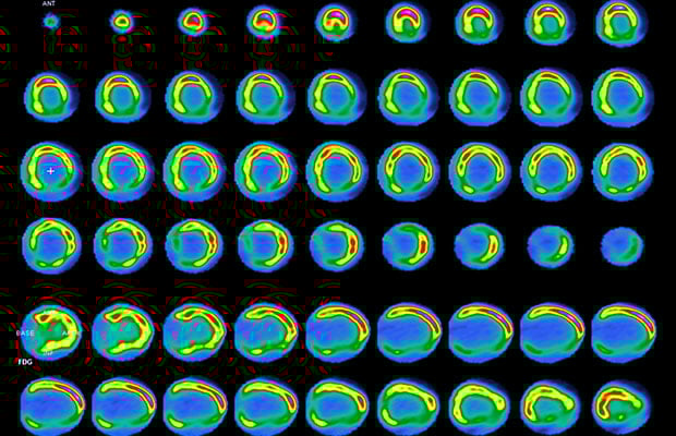 What is a PET scan? - BHF