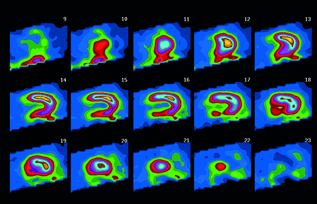 What is a SPECT scan? - Heart Matters - BHF