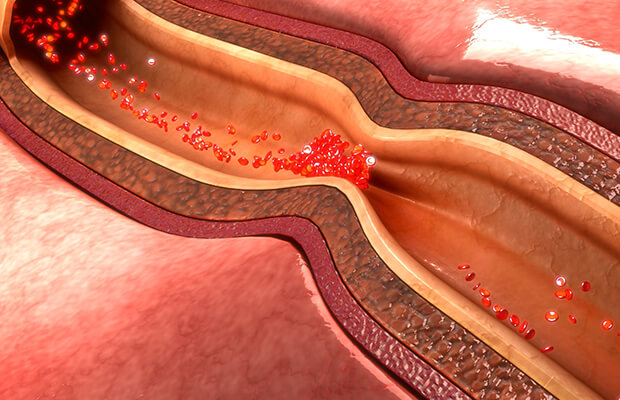Coronary artery spasm: What it is and the treatment options - BHF