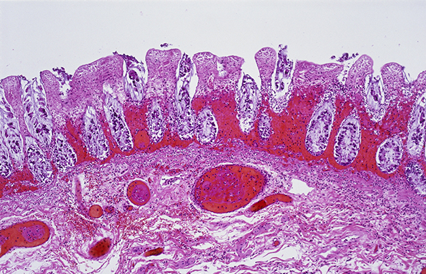 What is bowel ischaemia? - Heart Matters magazine - BHF