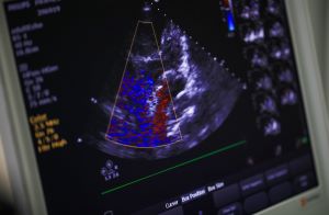 How to read an echocardiogram report - BHF
