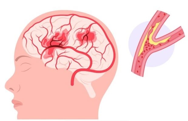 Transient ischaemic attack (TIA): what is a mini stroke? - BHF