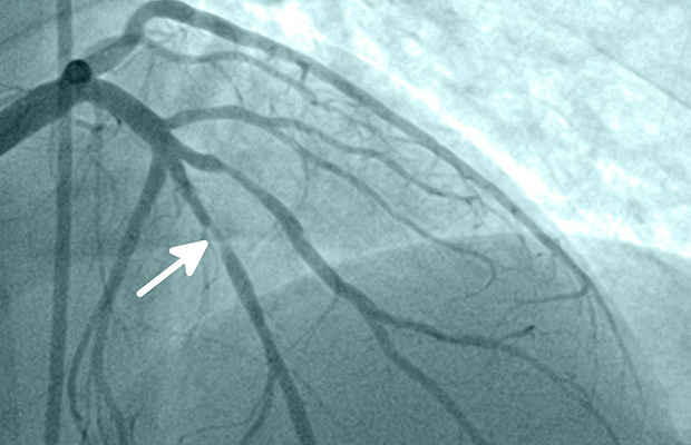Blocked arteries: what are the signs and symptoms? - BHF