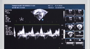 Echocardiogram Report