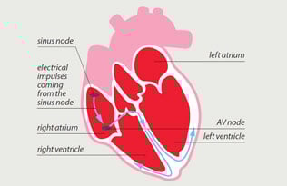 av node ablation uk