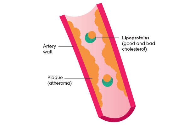 High cholesterol - symptoms, causes & levels - BHF