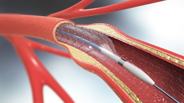 Coronary angioplasty and stents (PCI) - BHF