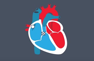 partial atrioventricular block