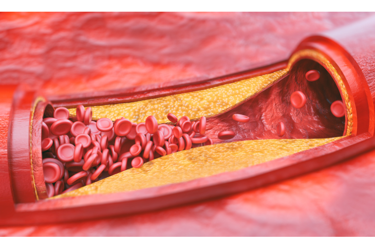 A new tool to assess severity of coronary heart disease - BHF