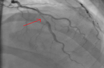 The mystery disease causing heart attacks in women - SCAD - BHF