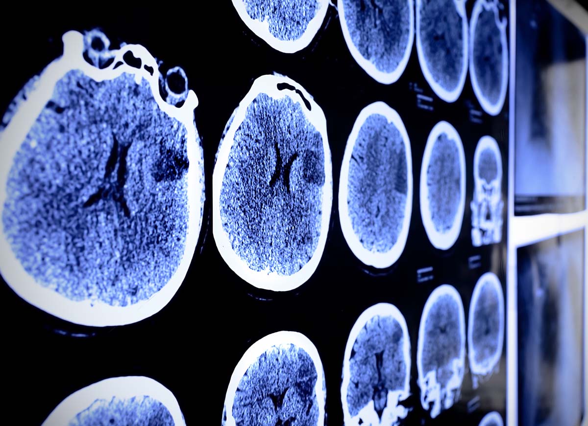 Stroke Brain Scan