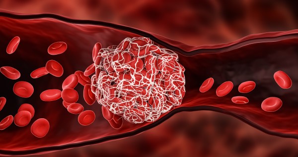 New clot busting drug could improve stroke treatment - BHF