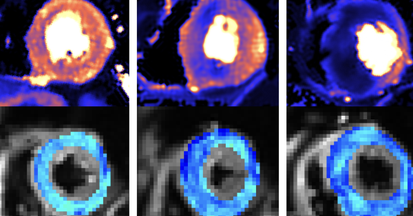 New scans can detect deadly heart condition before symptoms appear - BHF